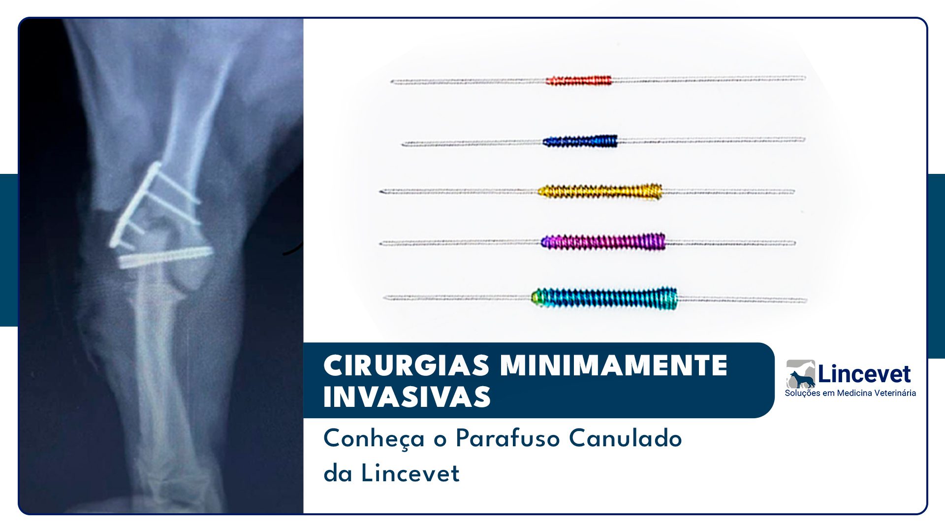 Cirurgias minimamente invasivas: Conheça o parafuso canulado da ...